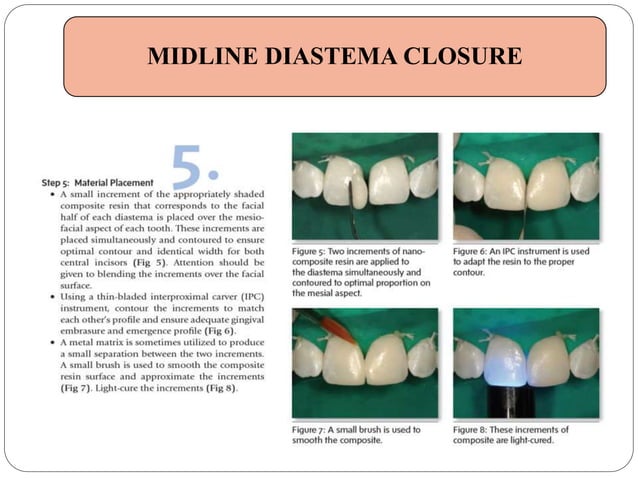 Class III, IV, V Cavity preparations for Composites- SELVI | PPTX