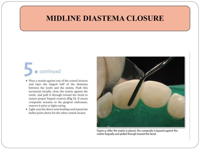 Class III, IV, V Cavity preparations for Composites- SELVI | PPTX
