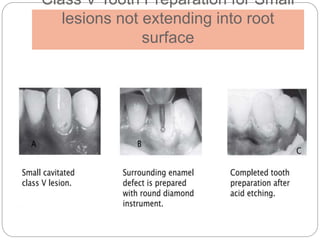 Class III, IV, V Cavity preparations for Composites- SELVI | PPTX
