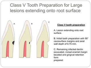 Class III, IV, V Cavity preparations for Composites- SELVI | PPTX