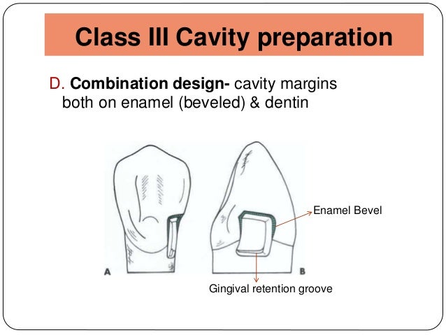 Class III, IV, V Cavity preparations for Composites- SELVI
