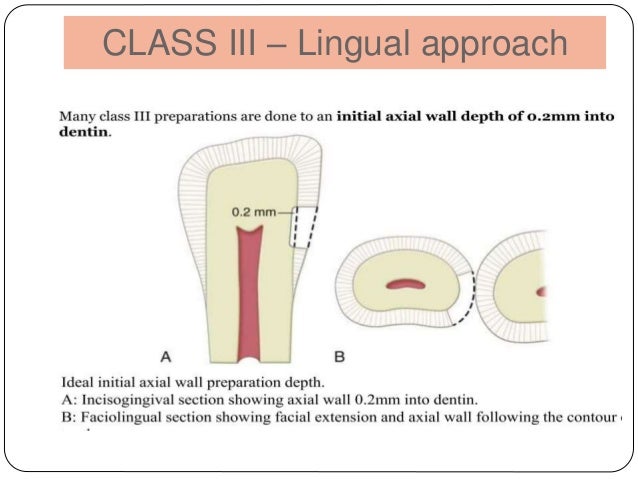 Class III, IV, V Cavity preparations for Composites- SELVI