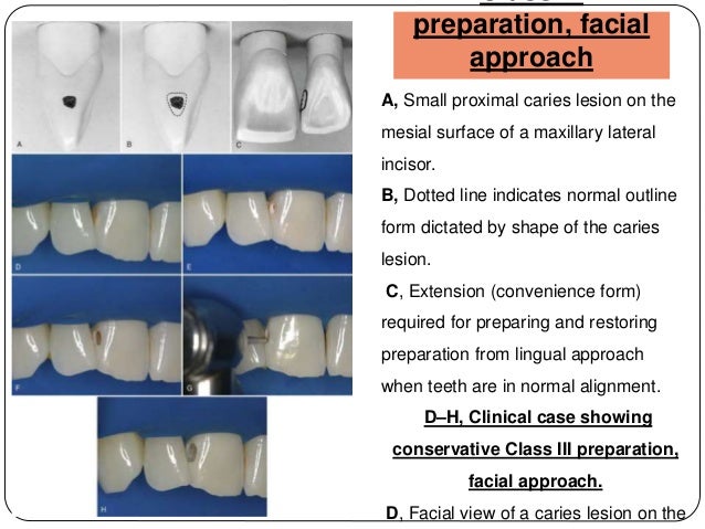Class III, IV, V Cavity preparations for Composites- SELVI