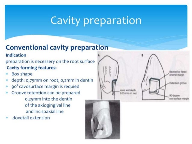 Class III, IV, V Cavity preparations for Composites- SELVI