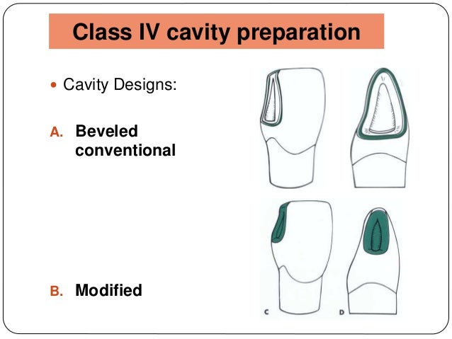 Class III, IV, V Cavity preparations for Composites- SELVI