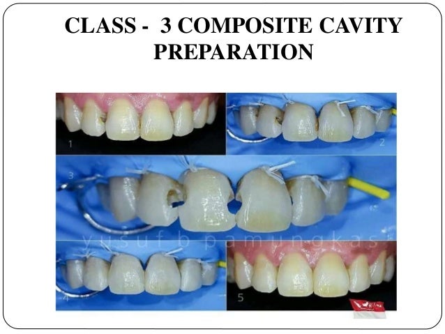 Class III, IV, V Cavity preparations for Composites- SELVI
