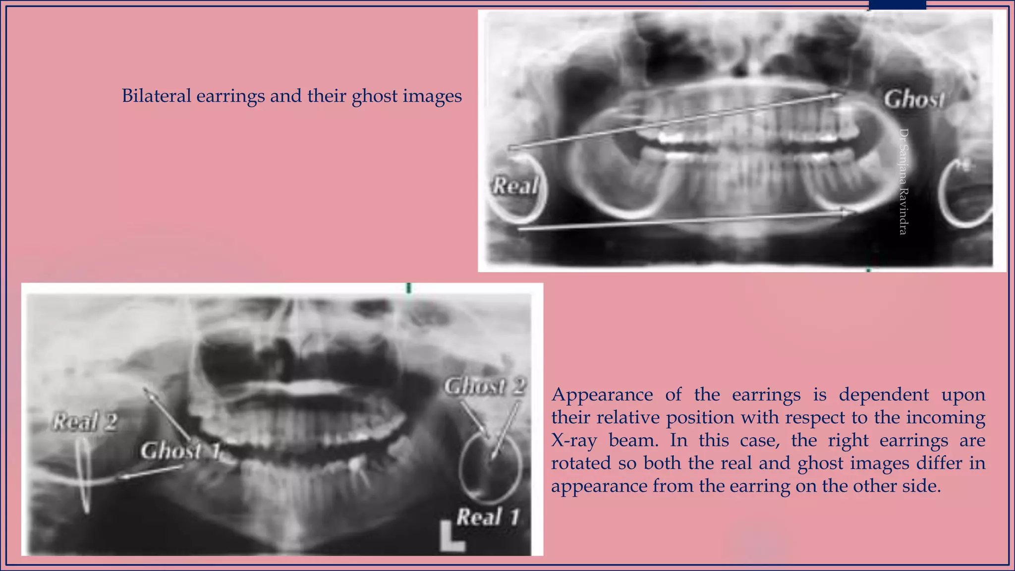 Panoramic radiography OPG | PPTX