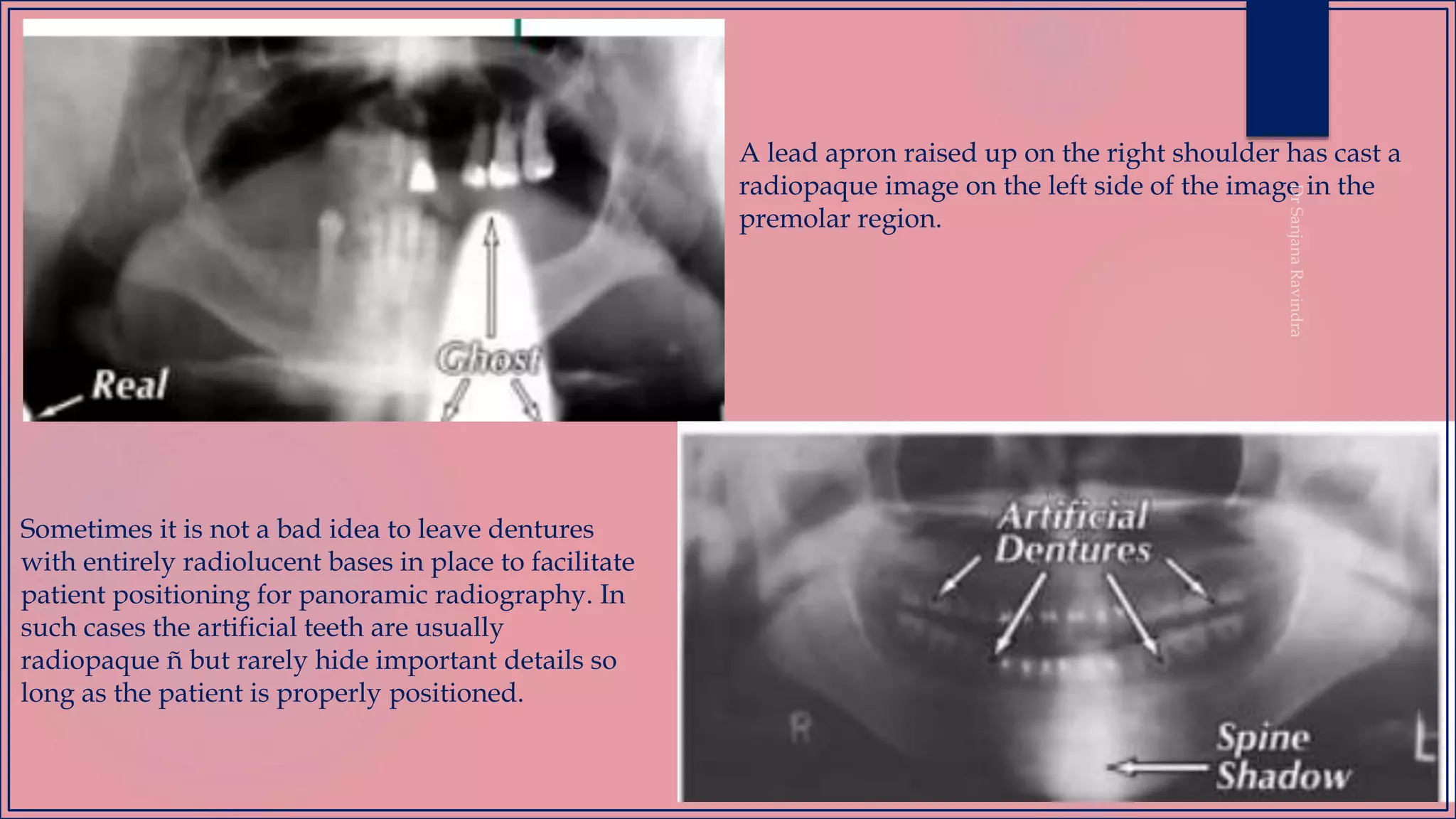 Panoramic radiography OPG | PPTX
