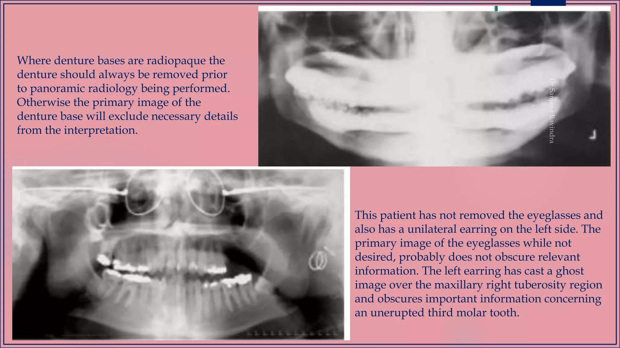 Panoramic radiography OPG | PPTX