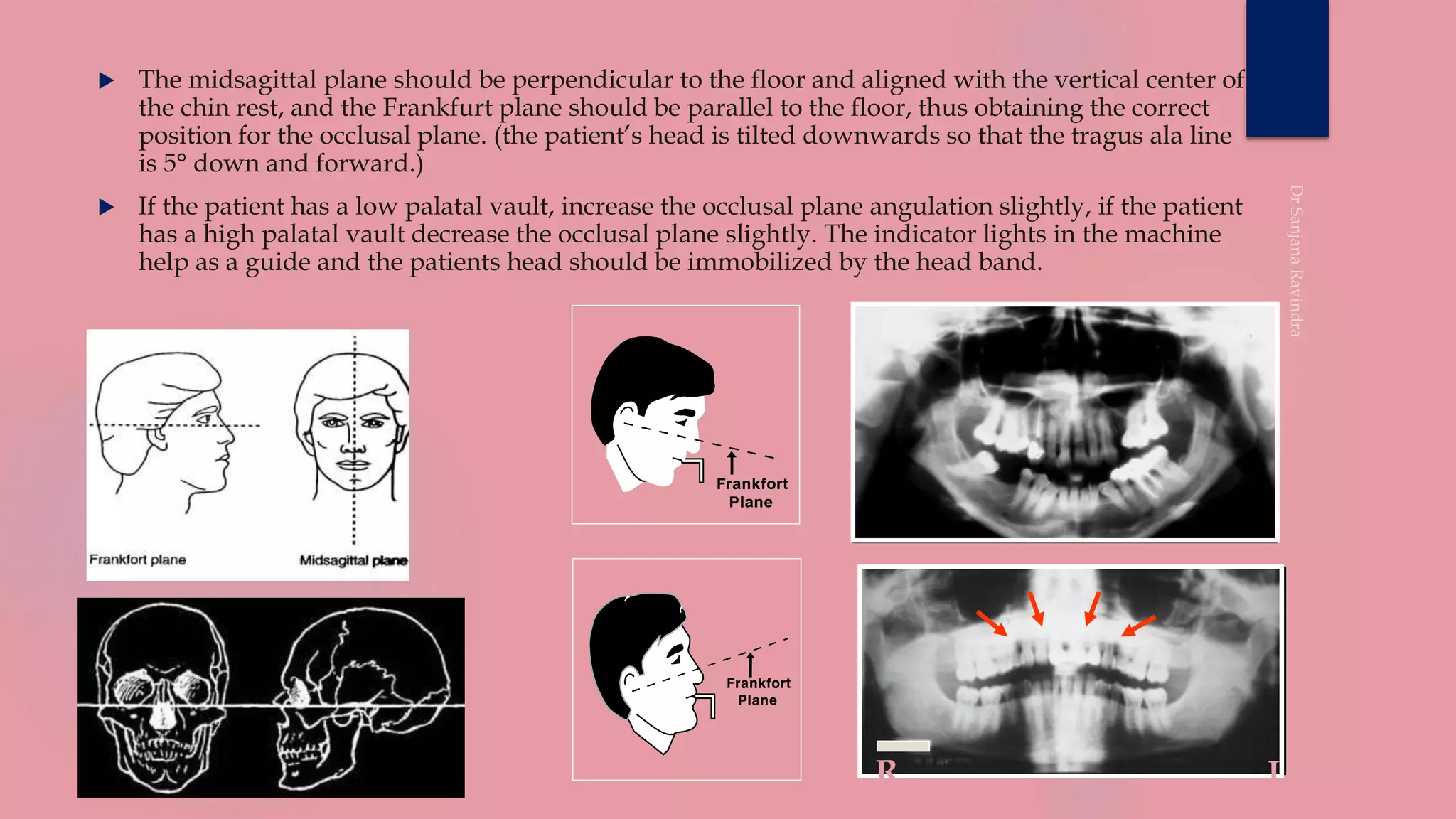 Panoramic radiography OPG | PPTX