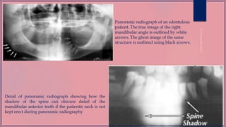 Panoramic radiography OPG | PPTX