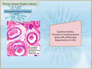 Herpetic Stomatitis Histology