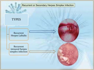 Intraoral Herpes Gums