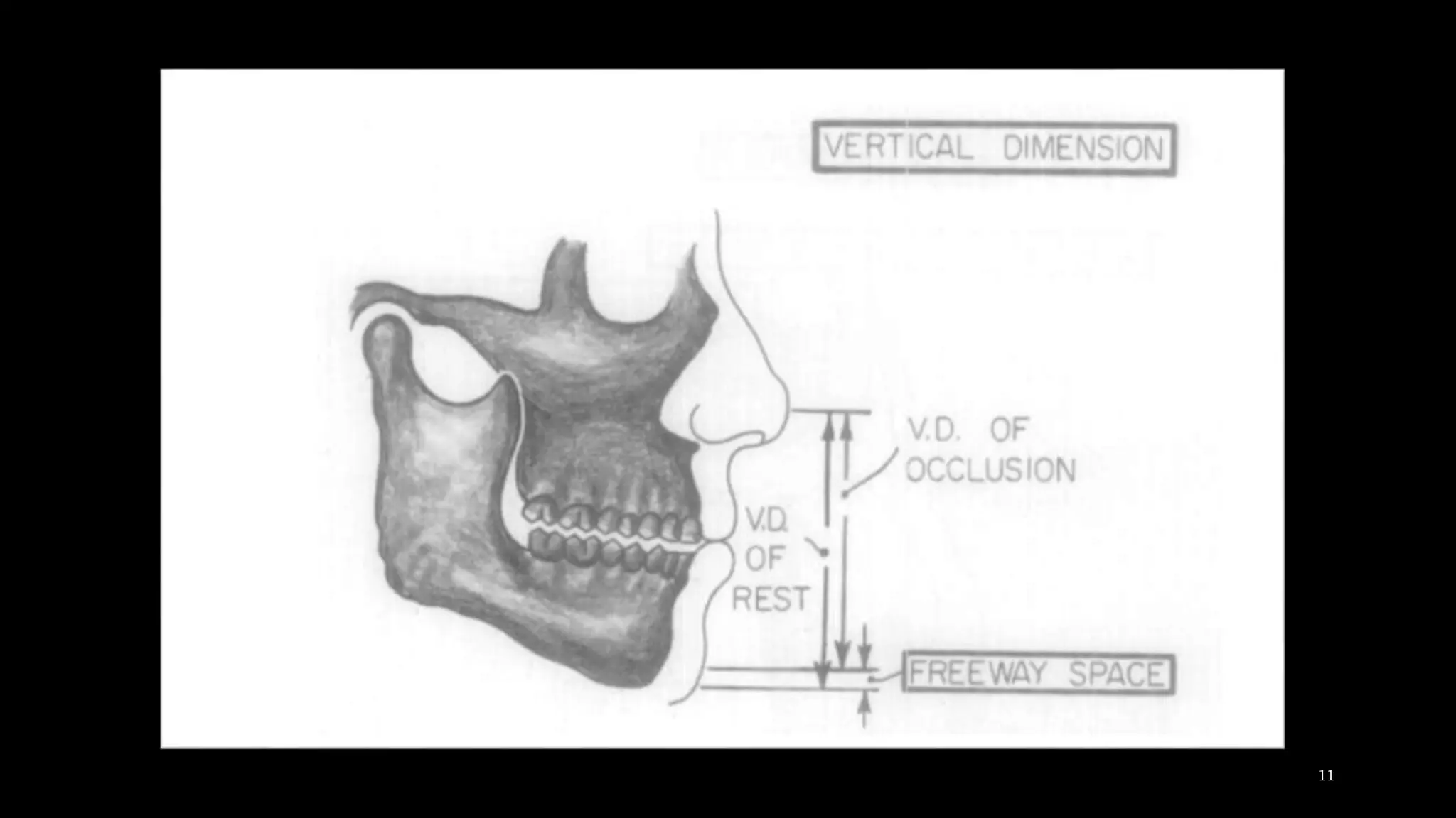 Vertical jaw relation in complete denture | PPTX
