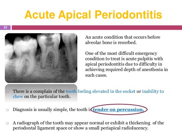 Acute Apical Periodontitis