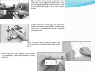 condylar position indicator | PDF