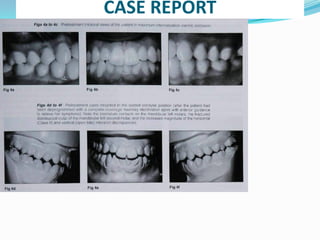 condylar position indicator | PDF