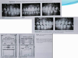 condylar position indicator | PDF