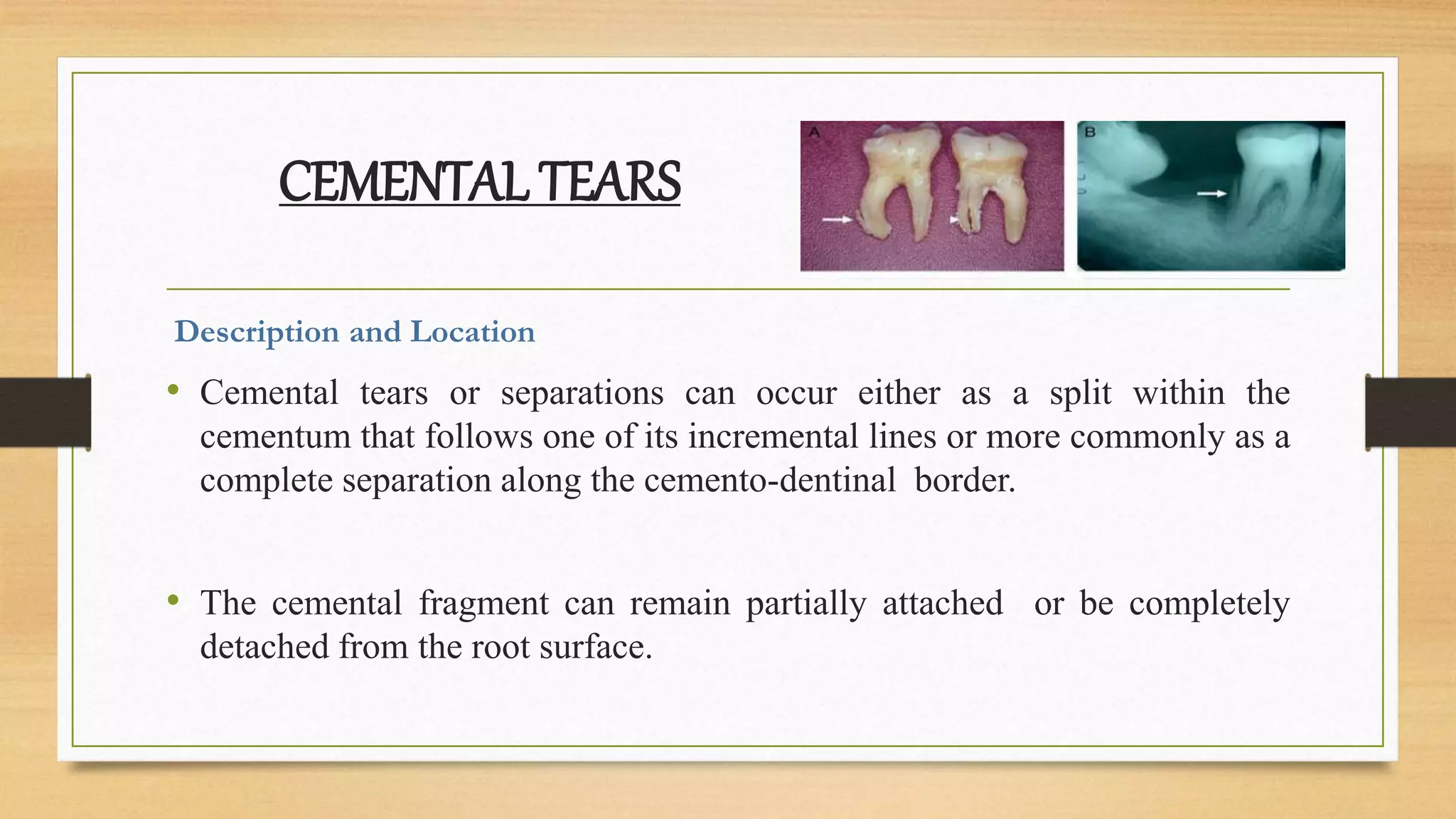 Cementum | PPTX