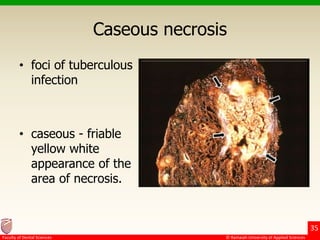 Caseous Necrosis Gross