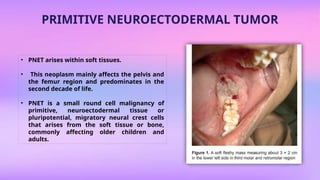 ROUND CELL LESION OF ORAL CAVITY .pptx