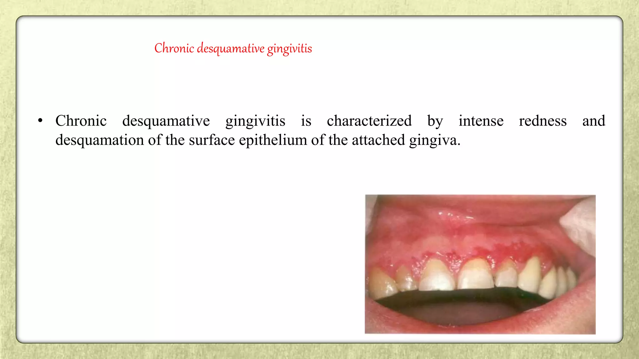desquamative gingivitis | PPTX