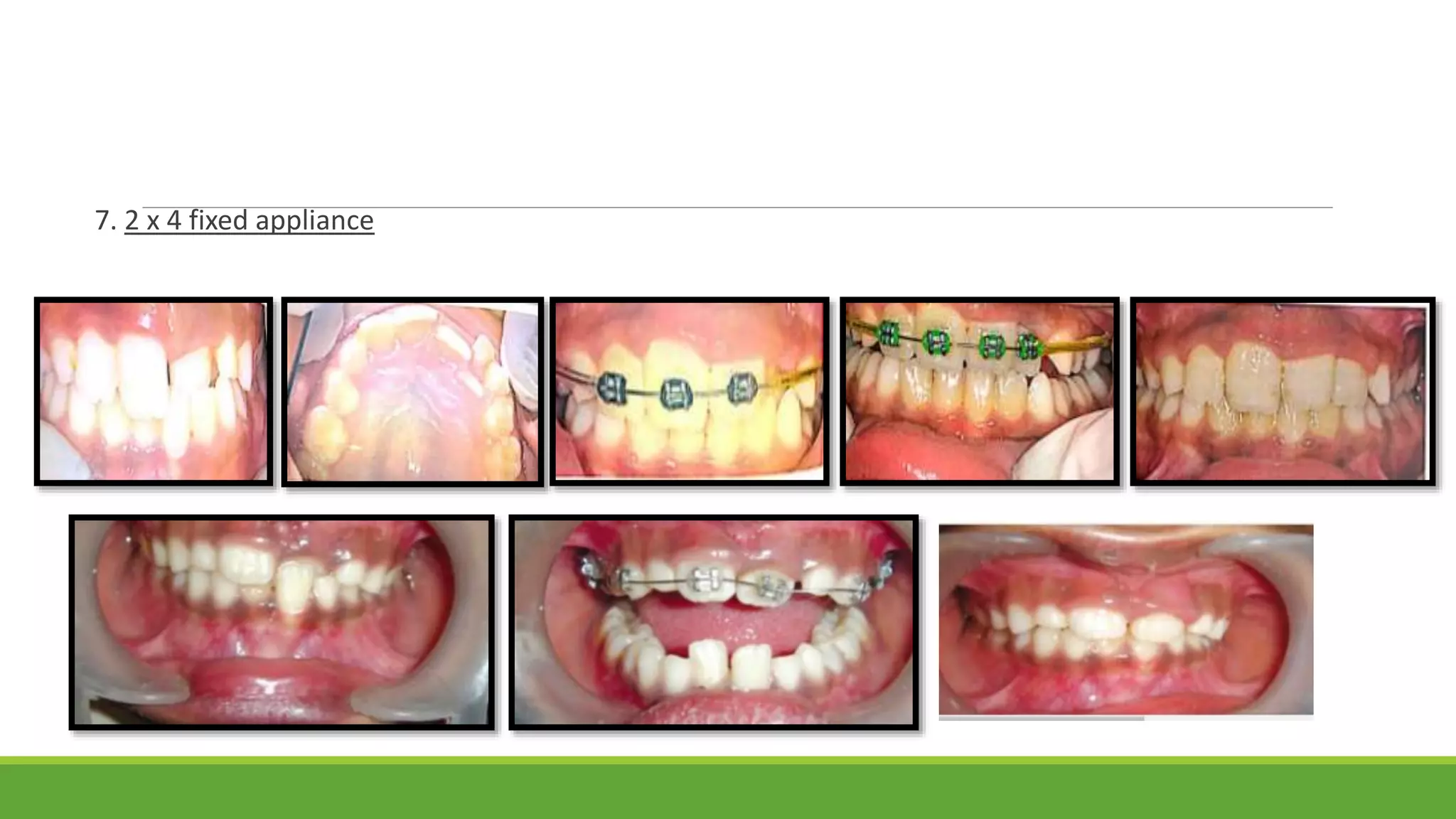 INTERCEPTIVE ORTHODONTICS | PPTX