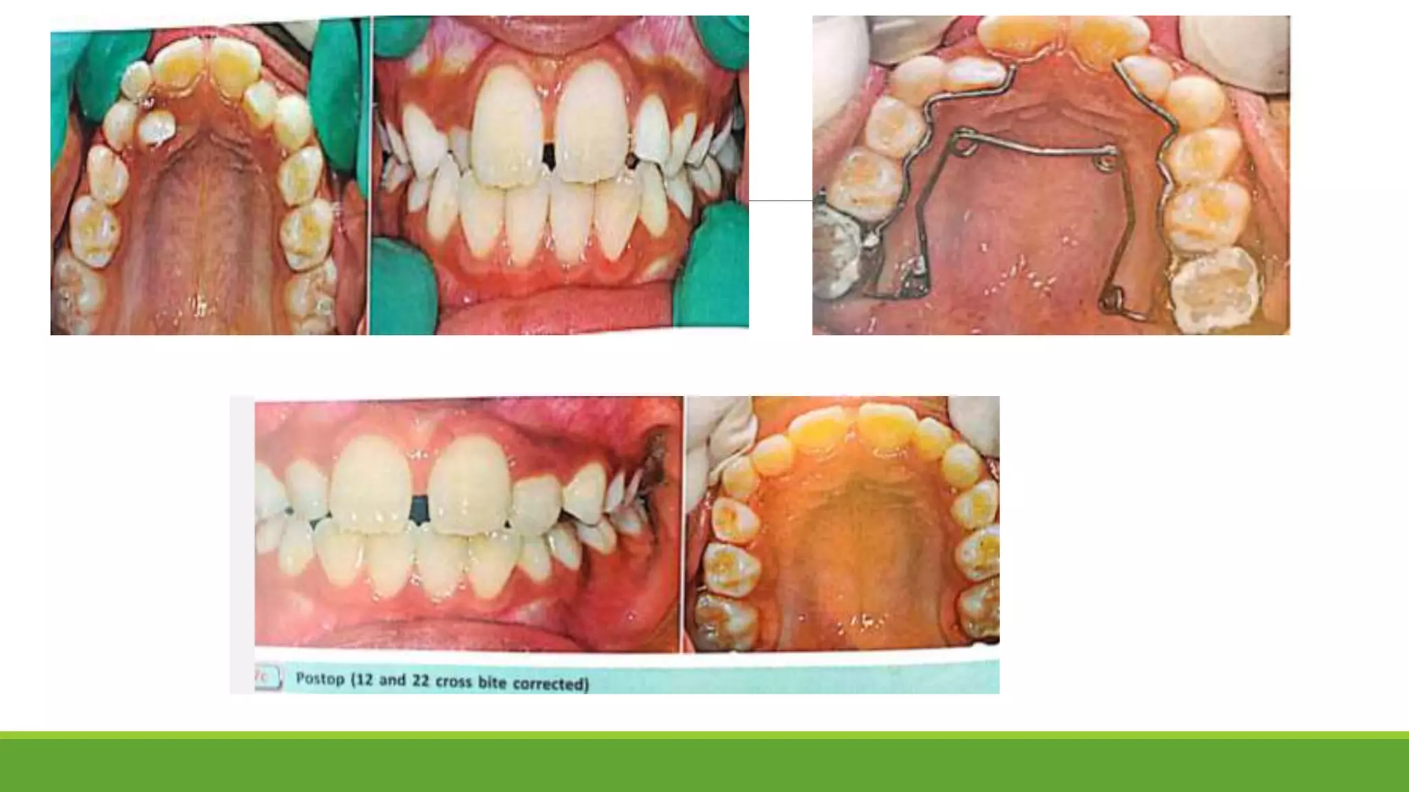 INTERCEPTIVE ORTHODONTICS | PPTX