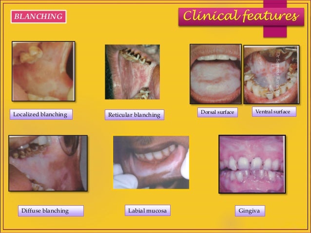 Oral Submucous Fibrosis - OSMF : Dr Sanjana Ravindra