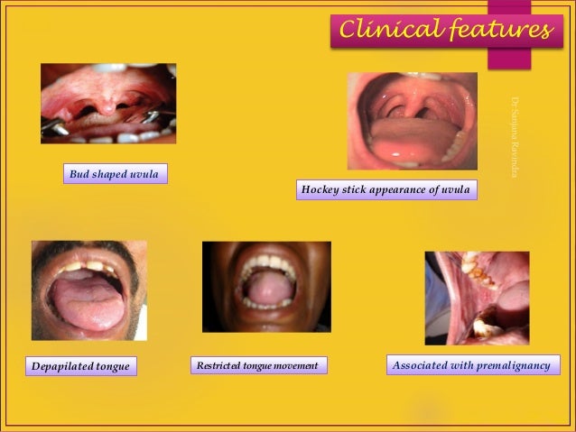 Oral Submucous Fibrosis - OSMF : Dr Sanjana Ravindra