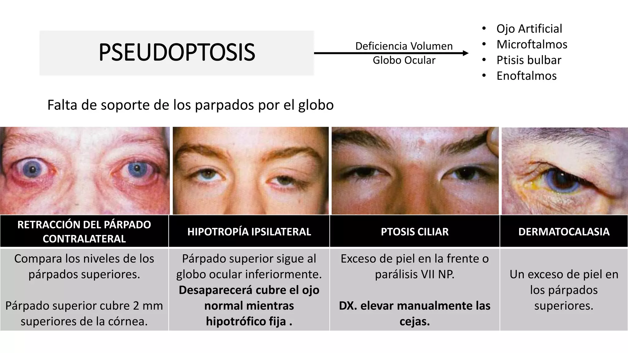 SEMANA 1. PTOSIS PARPEBRAL1.pdf