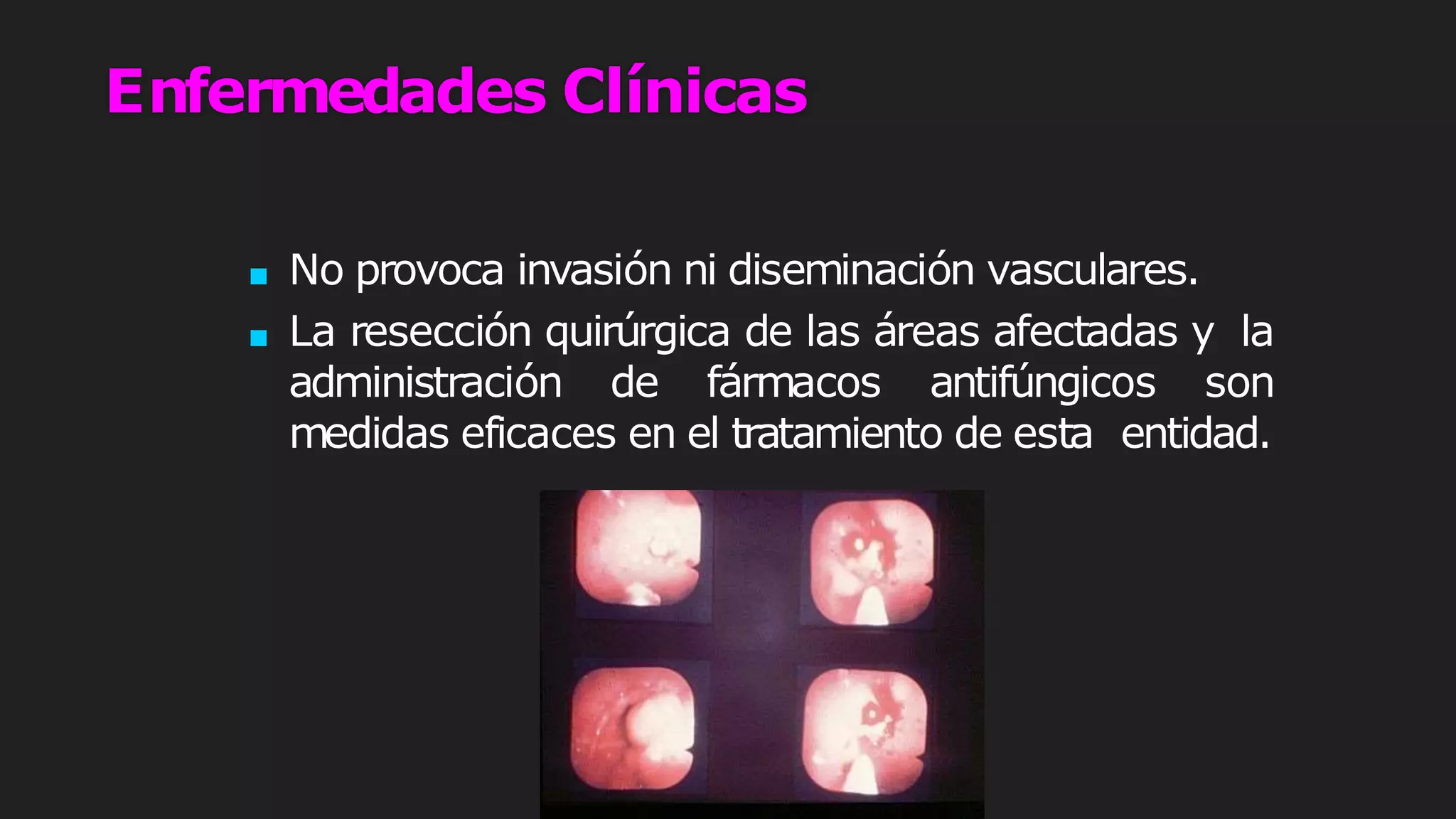 SEMANA 14- ASPERGILOSIS, MUCOR, ZYGOMICOSIS.pptx