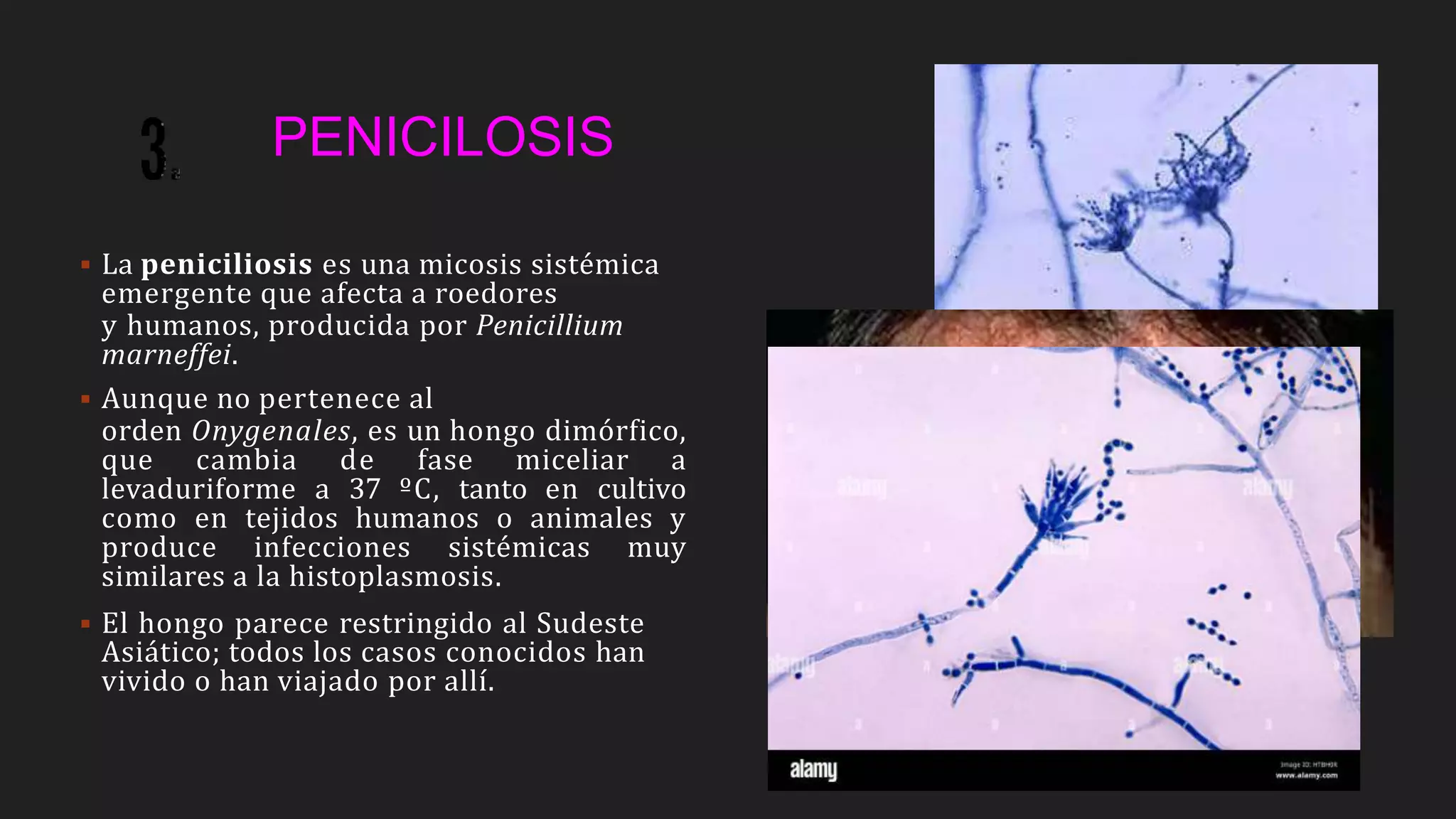 SEMANA 14- ASPERGILOSIS, MUCOR, ZYGOMICOSIS.pptx