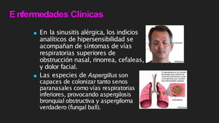 SEMANA 14- ASPERGILOSIS, MUCOR, ZYGOMICOSIS.pptx