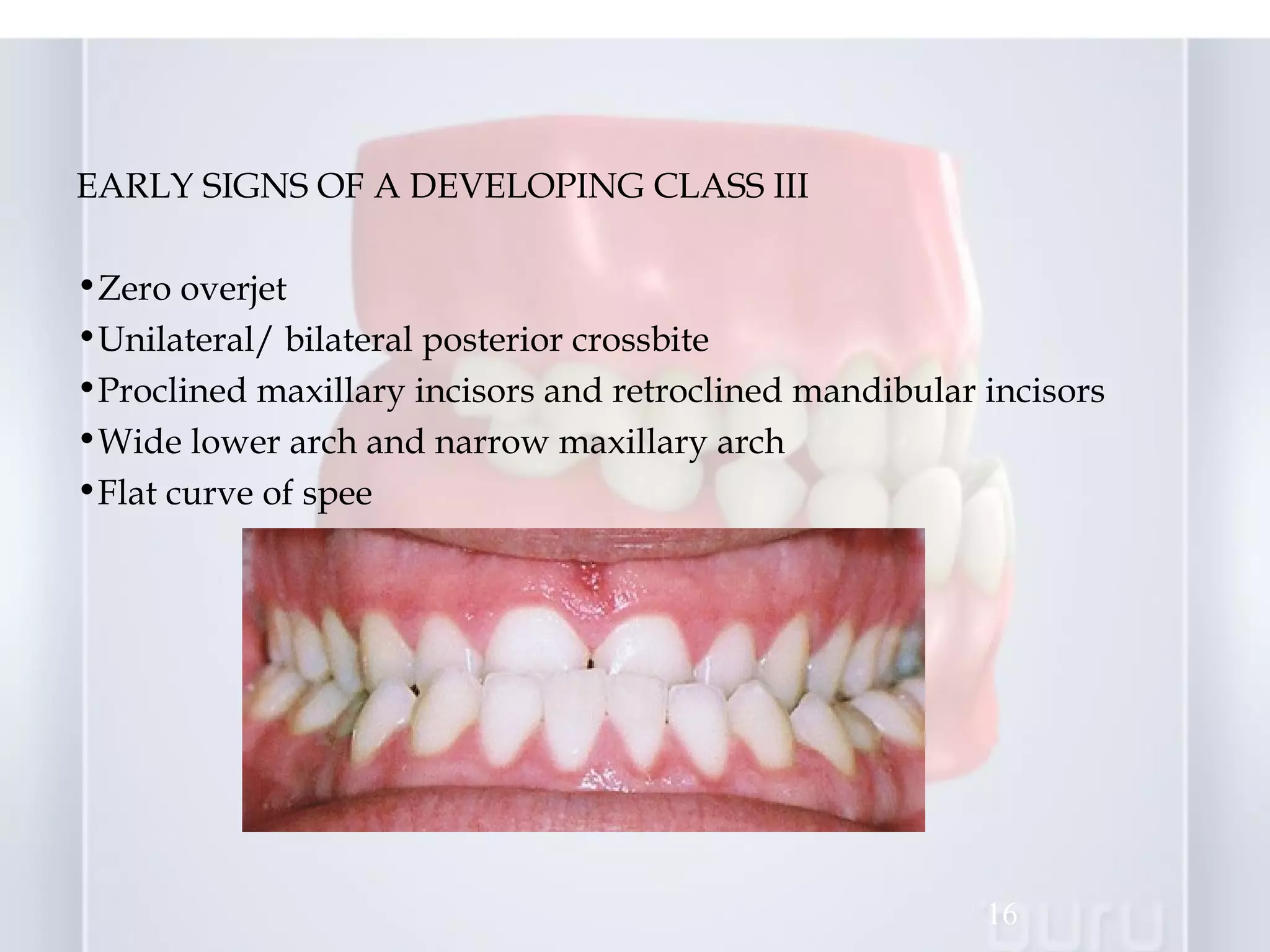 early treatment of class III malocclusion | PPT