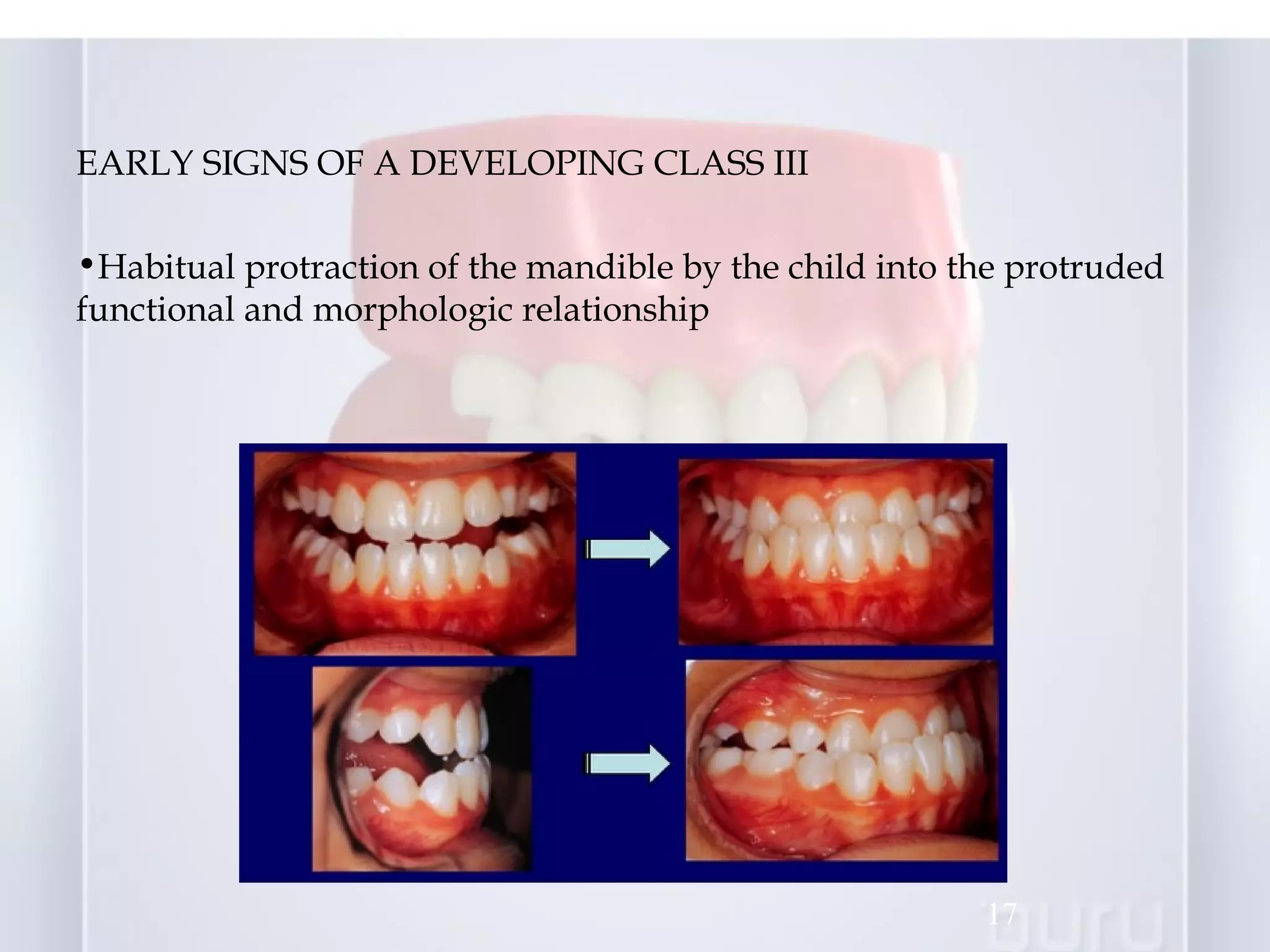 early treatment of class III malocclusion | PPT