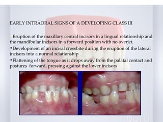 early treatment of class III malocclusion | PPT