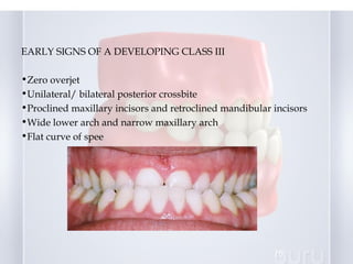 early treatment of class III malocclusion | PPT