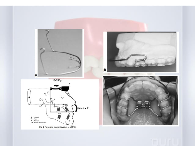 early treatment of class III malocclusion | PPT