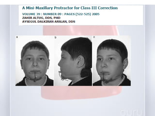 early treatment of class III malocclusion | PPT