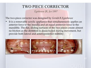 early treatment of class III malocclusion | PPT