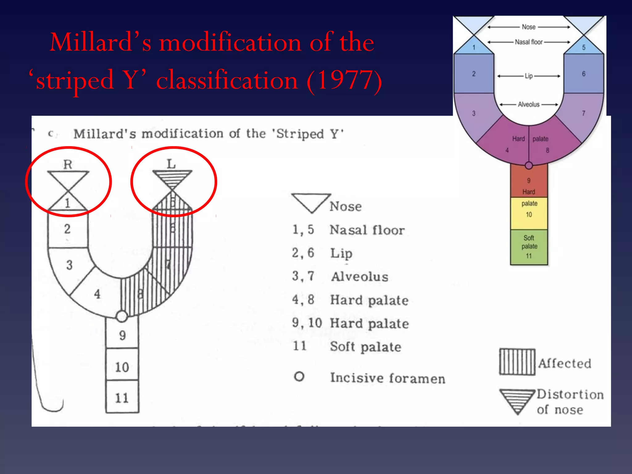 cleft lip and palate part 1 | PPT