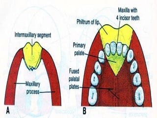 Cleft Lip And Palate Diagram