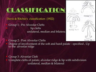 cleft lip and palate part 1 | PPT
