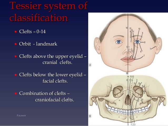 cleft lip and palate part 1