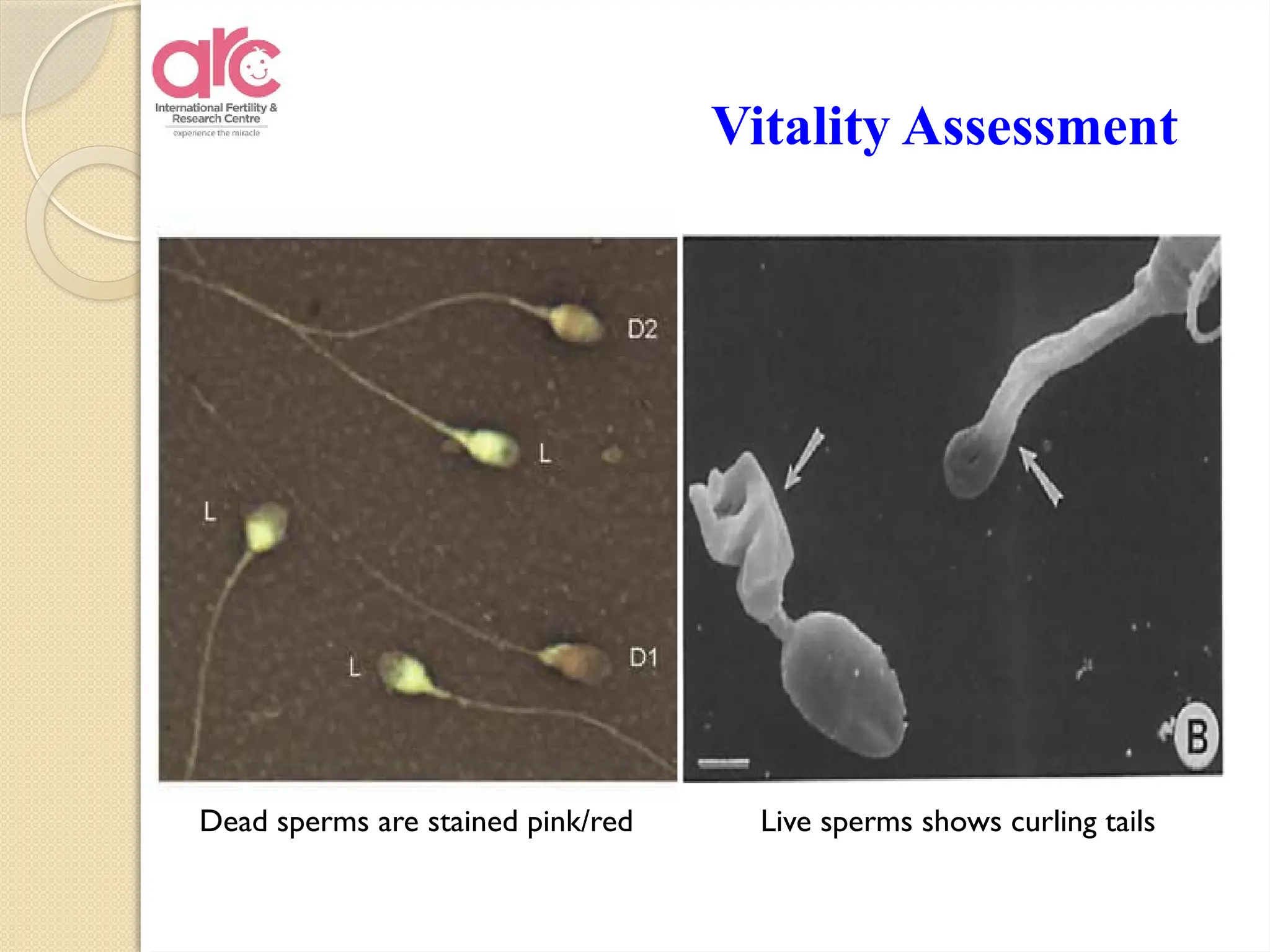 semenanalysis BY ARC FERTILITY CENTREpptx | PPTX
