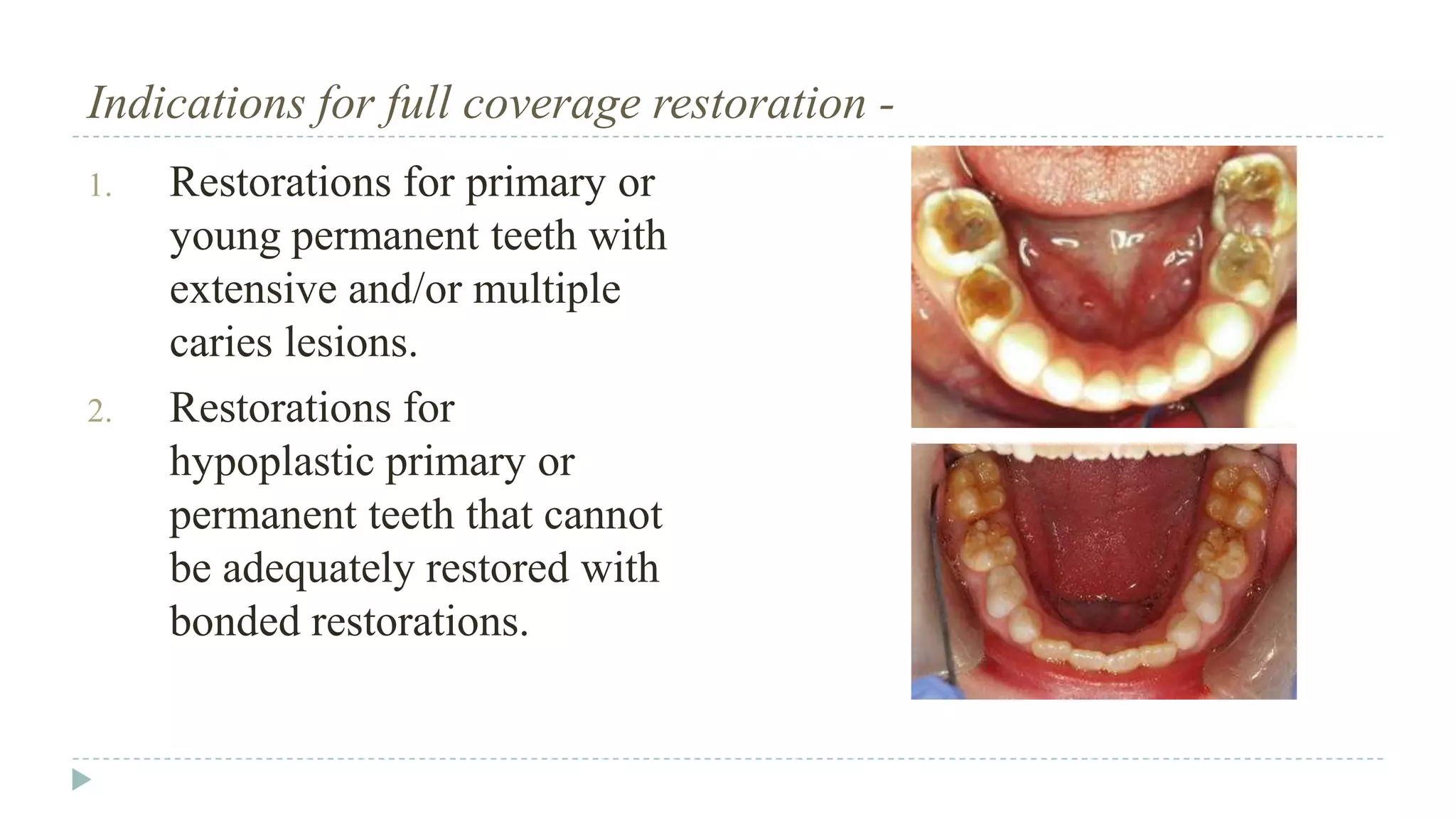 Semi permanent crowns | PPTX