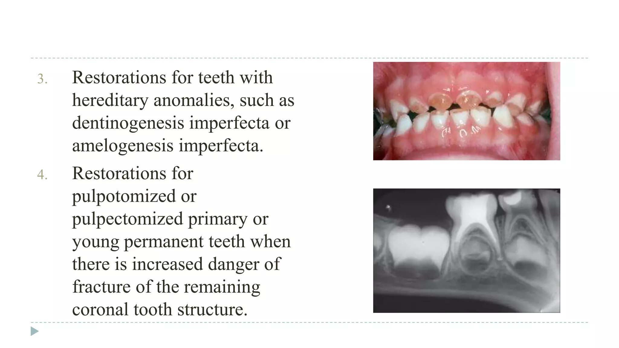 Semi permanent crowns | PPTX