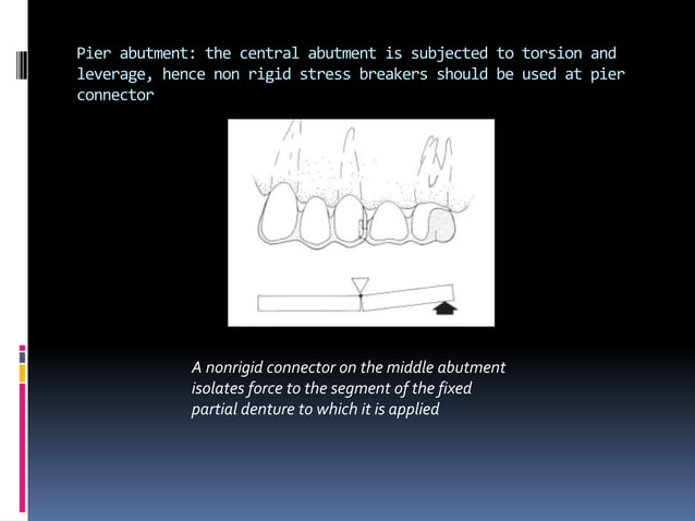 FIXED PARTIAL DENTURE -DESIGN CONSIDERATION | PPTX