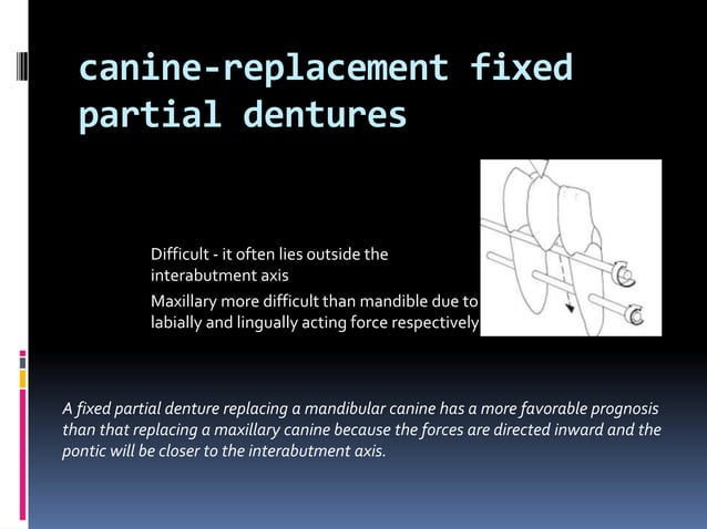 FIXED PARTIAL DENTURE -DESIGN CONSIDERATION | PPTX